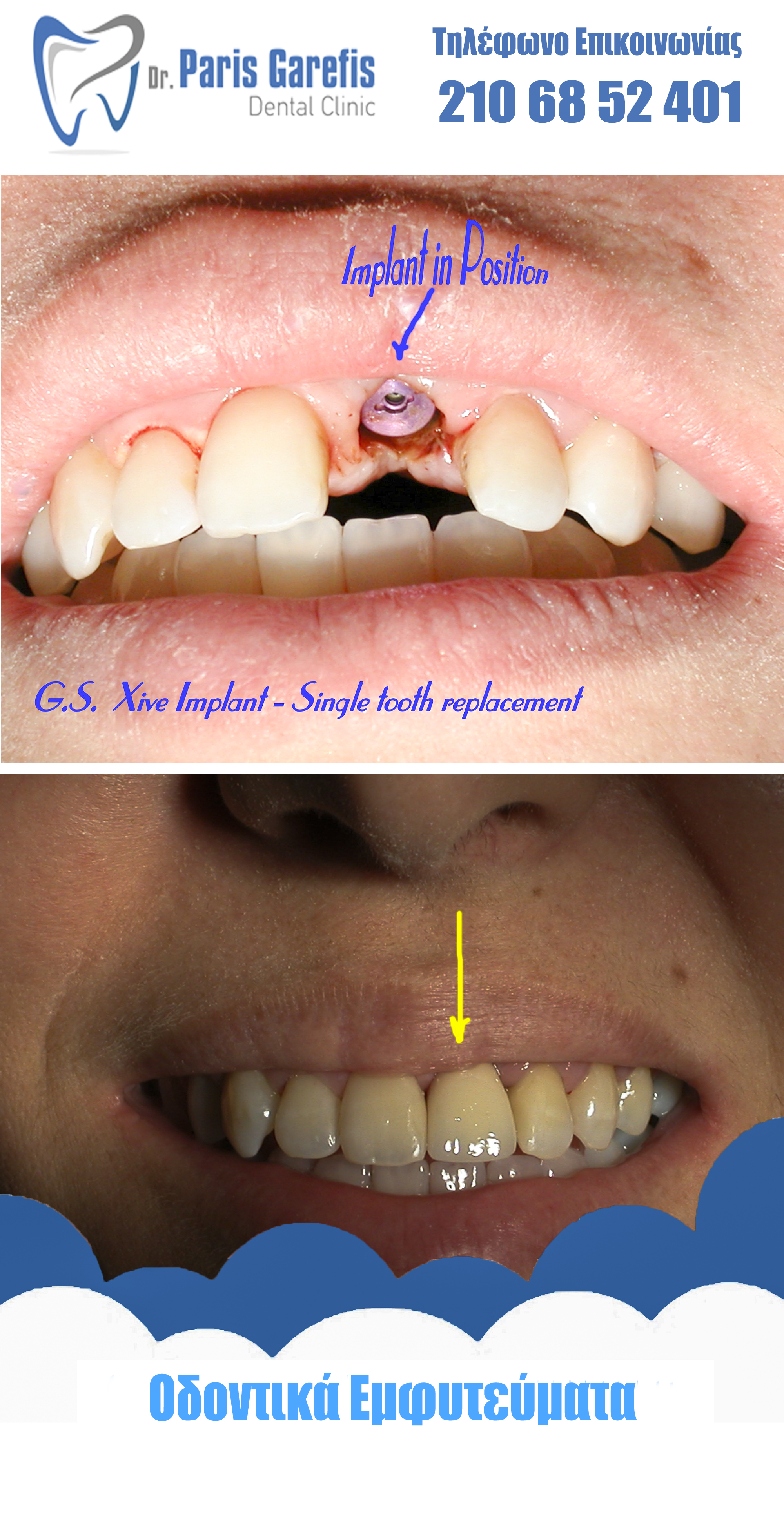 Οδοντικά Εμφυτεύματα - Dr Paris Garefis